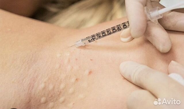 Лечение гипергидроза повышенного потоотделения в Липецке Услуги Авито